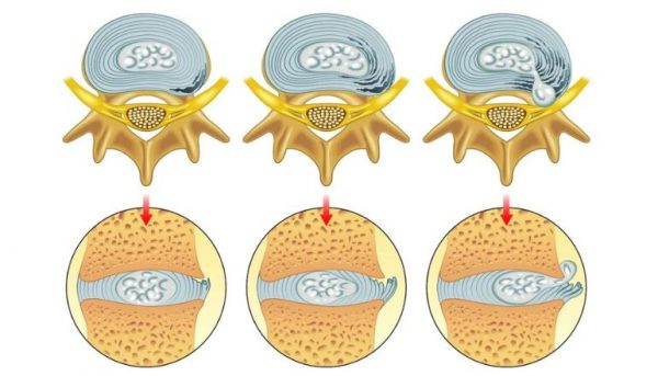 ¿Qué es una protrusión discal? - Clínica IVEMA Valencia. Columna ...